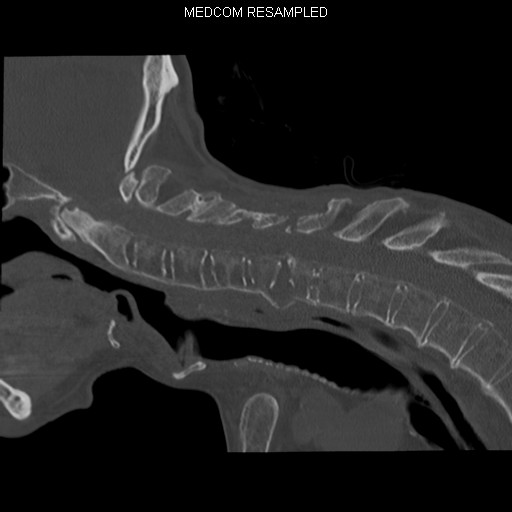 missed diagnosis in traumatic spine – atmghn